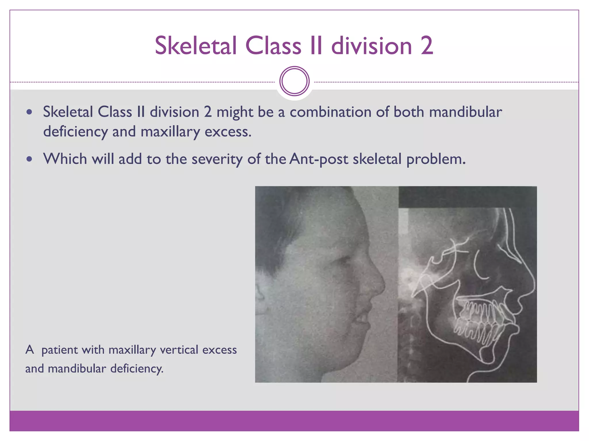 Class II division 2 malocclusion | PPTX