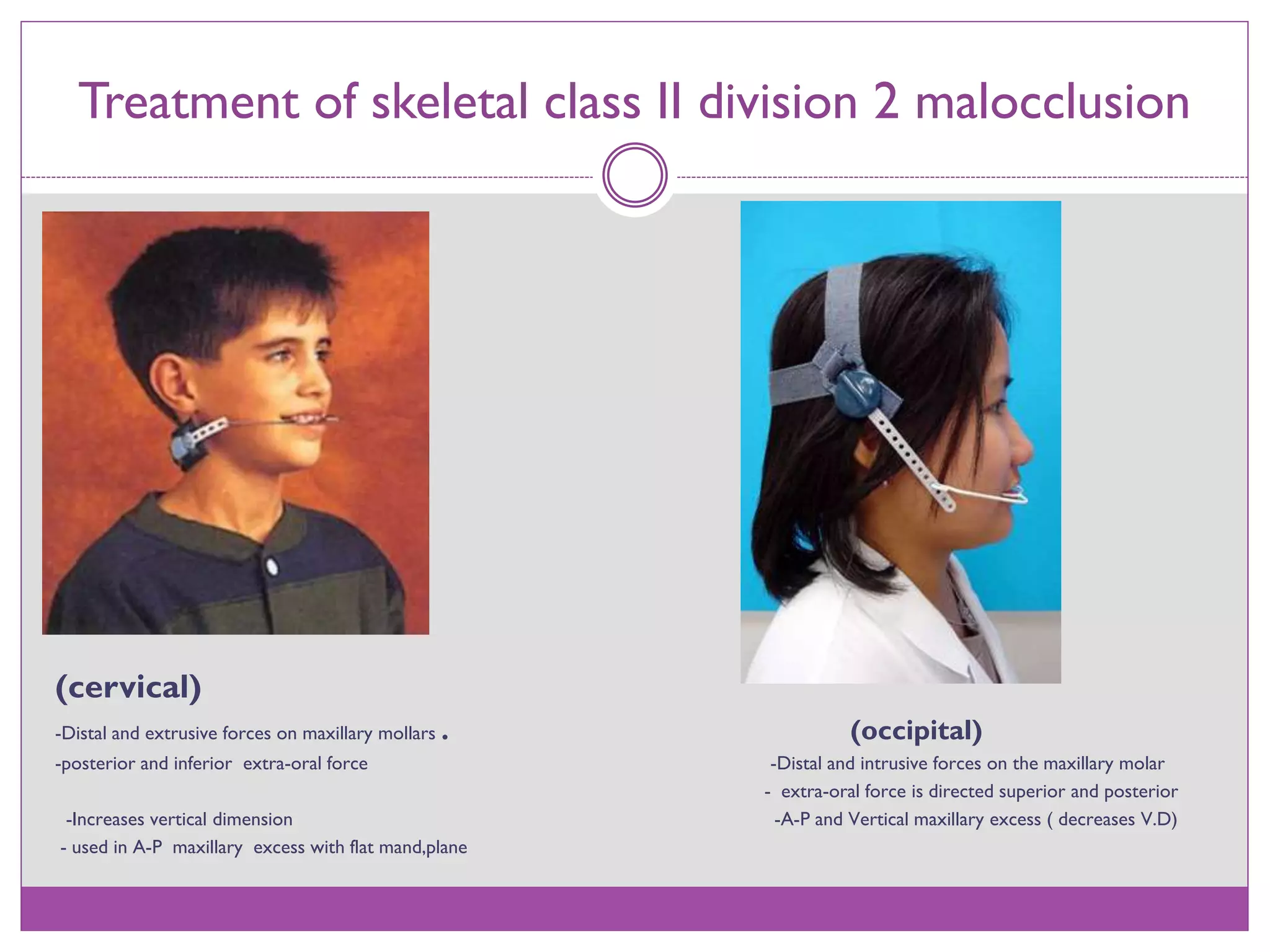 Class II division 2 malocclusion | PPTX