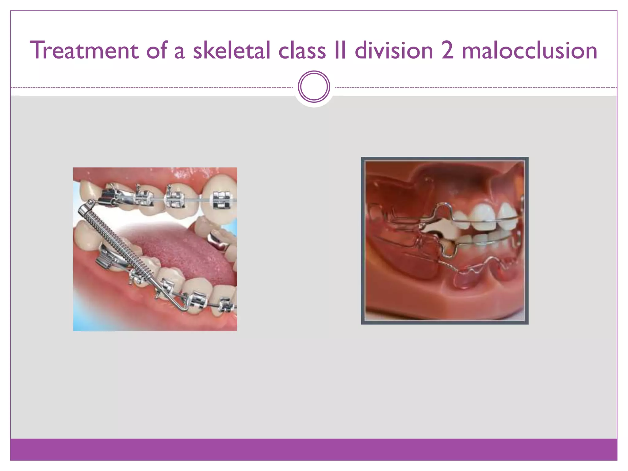 Class II division 2 malocclusion | PPTX