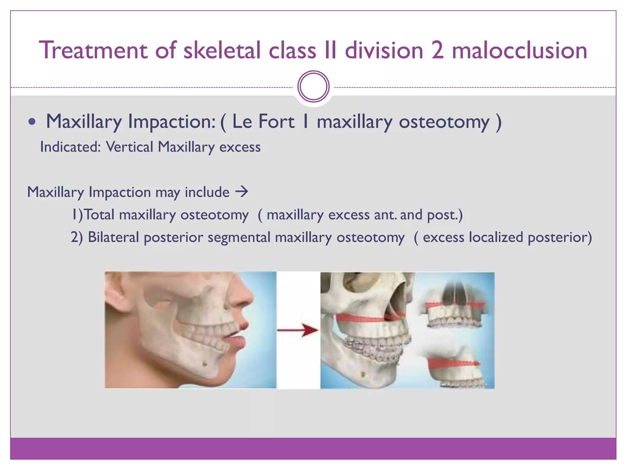 Class II division 2 malocclusion | PPTX