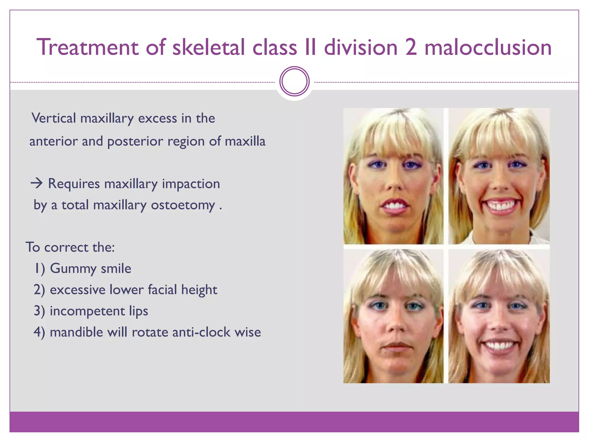 Class II division 2 malocclusion | PPTX
