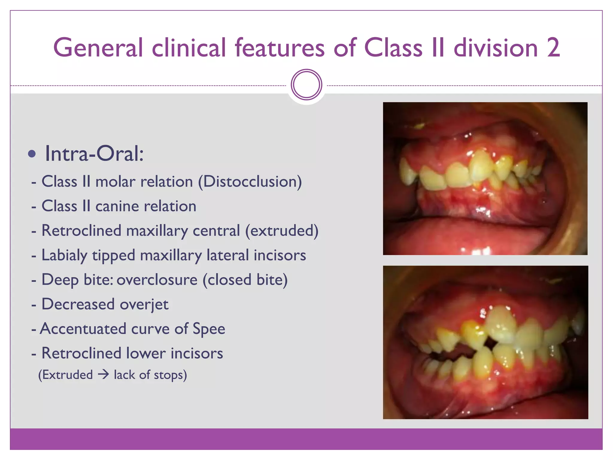 Class II division 2 malocclusion | PPTX