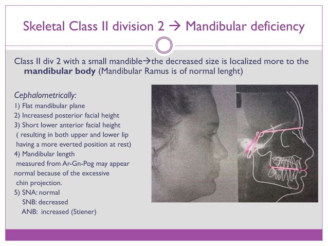 Class II division 2 malocclusion | PPTX