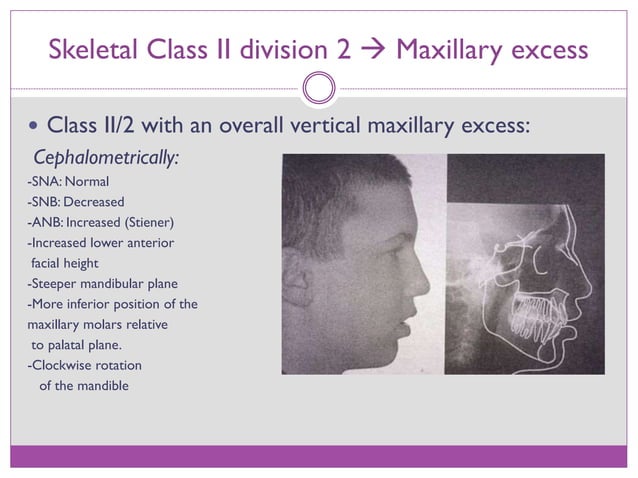 Class II division 2 malocclusion | PPTX