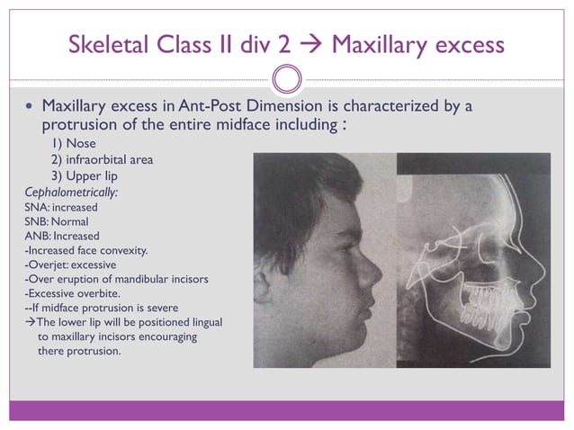 Class II division 2 malocclusion | PPTX