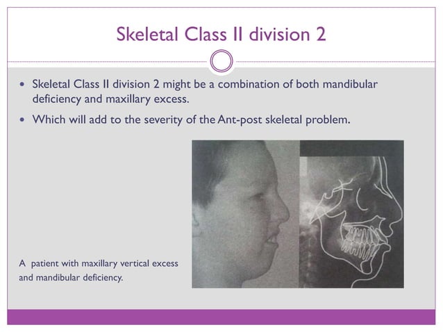 Class II division 2 malocclusion | PPTX