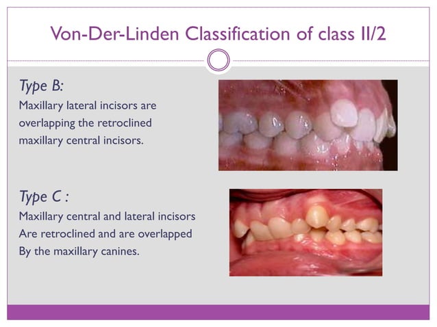 Class II division 2 malocclusion | PPTX
