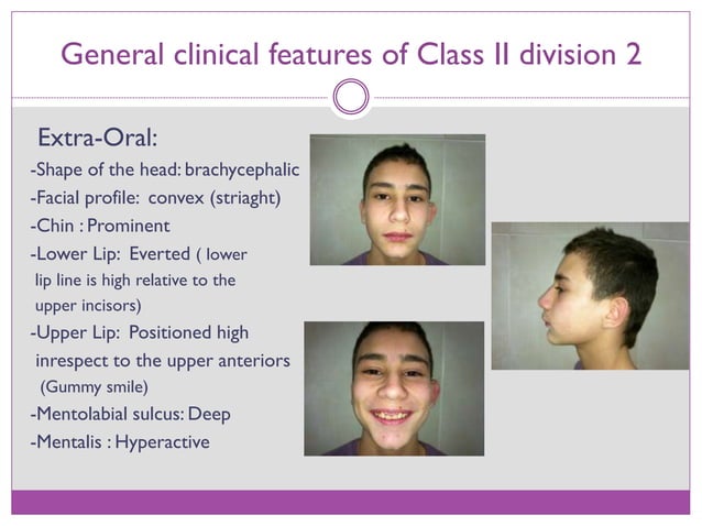 Class II division 2 malocclusion | PPTX