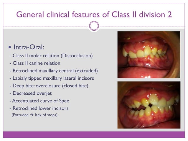 Class II division 2 malocclusion | PPTX