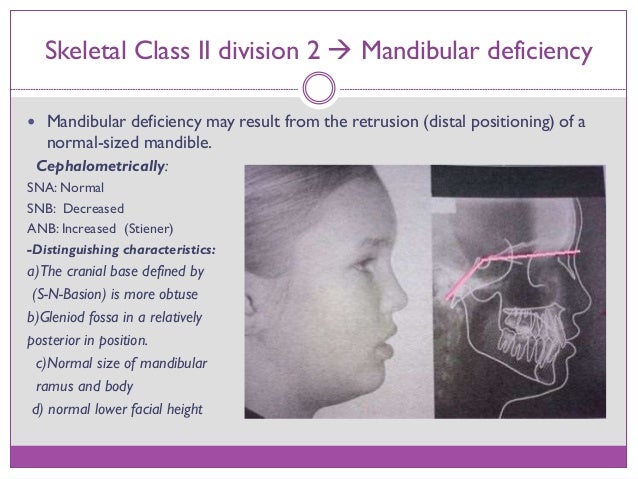 Class II division 2 malocclusion