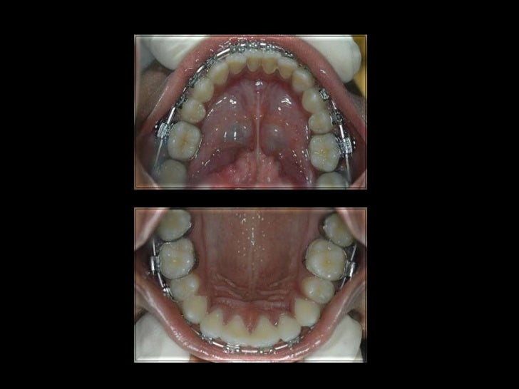 Orthodontic Case Report - Class III