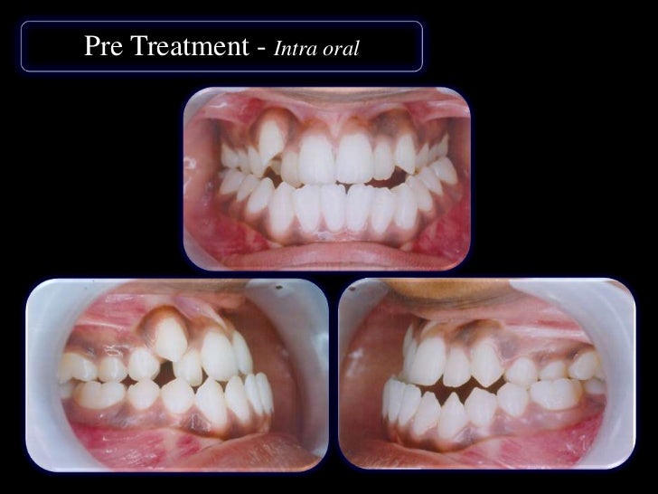 Orthodontic Case Report - Class III