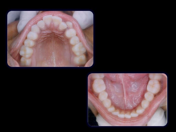 Orthodontic Case Report - Class III