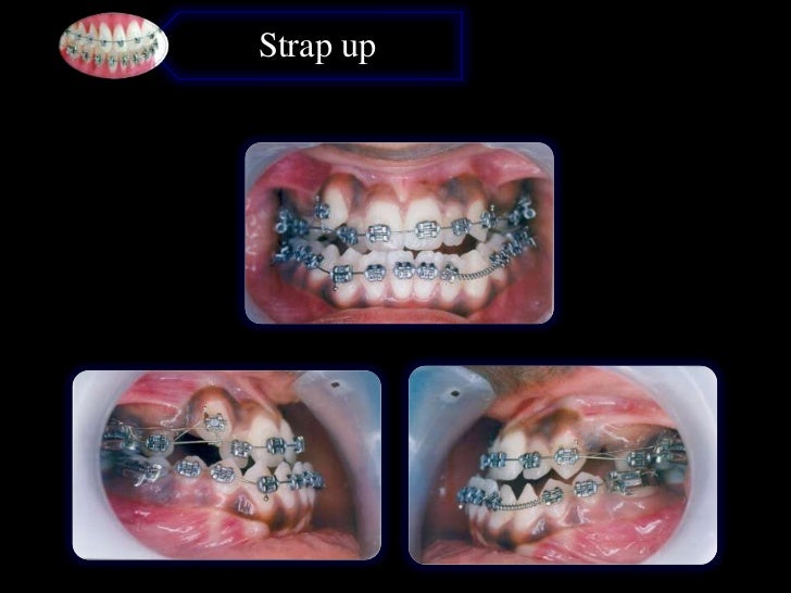 Orthodontic Case Report - Class III