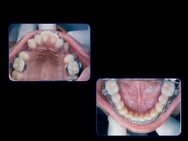 Orthodontic Case Report - Class III