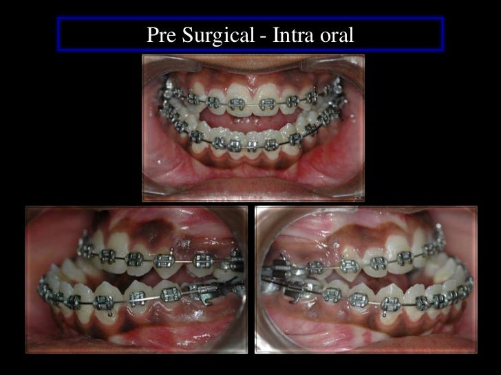 Orthodontic Case Report - Class III