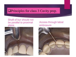Class III cavity preparation | PPTX
