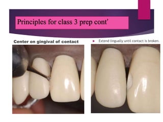 Class III cavity preparation | PPTX