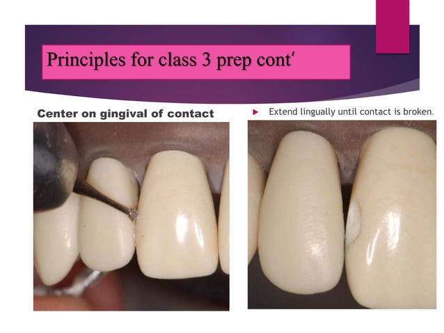 Class III cavity preparation | PPTX | Dental Health | Diseases and ...