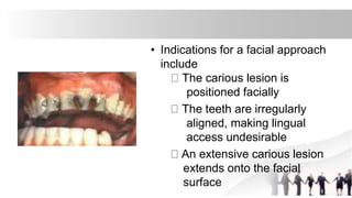 Class iii cavity preparation | PPTX
