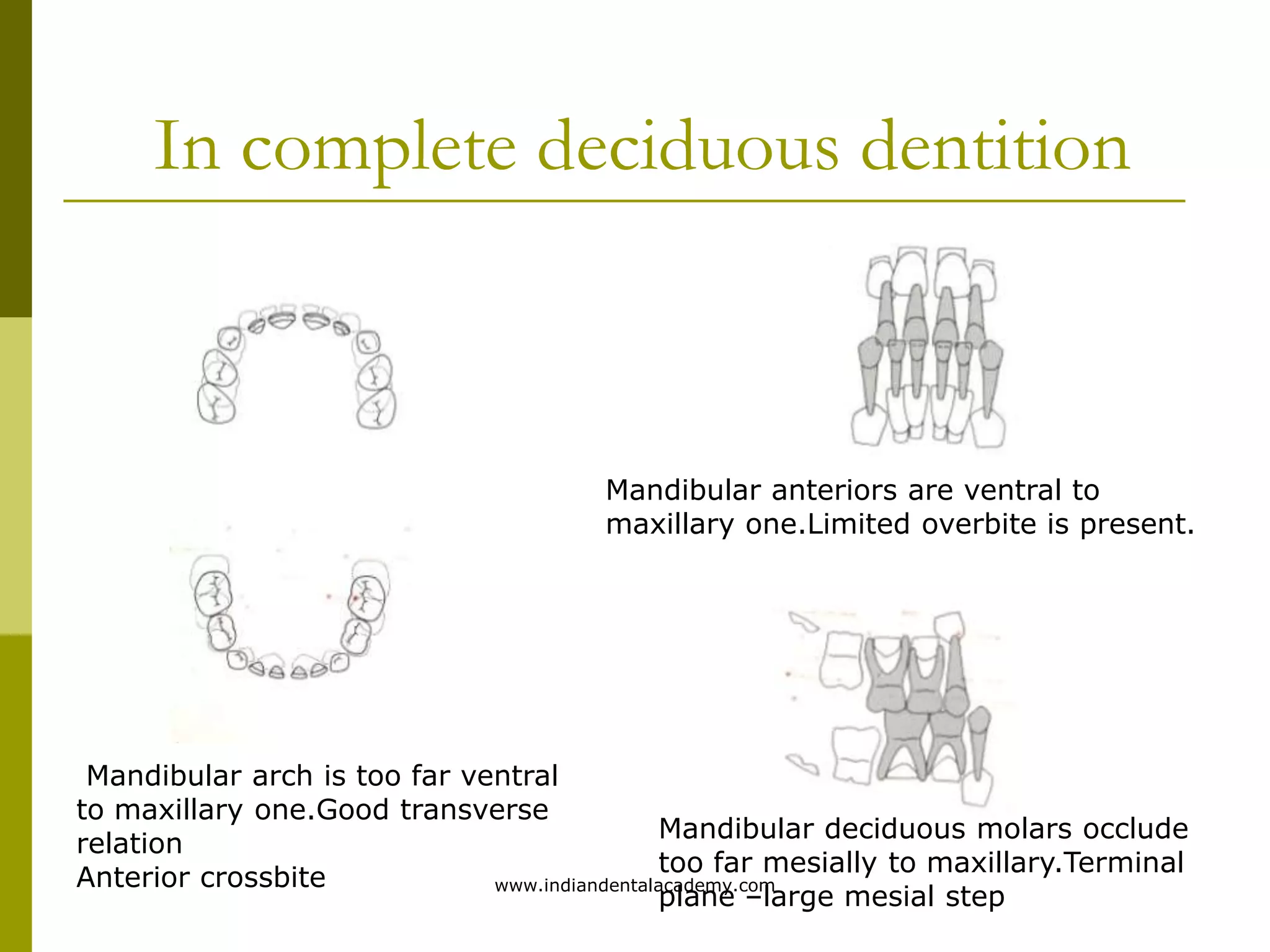Class 3 malocclusions /certified fixed orthodontic courses by Indian ...