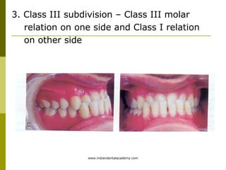 Angles Class 3 malocclusion / fixed orthodontics courses online | PPT
