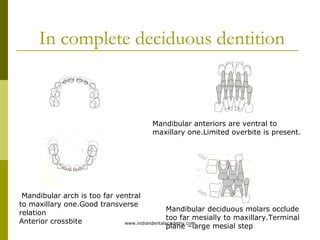 Angles Class 3 malocclusion | PPT