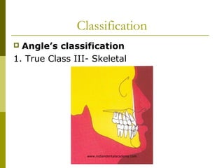 Angles Class 3 malocclusion | PPT