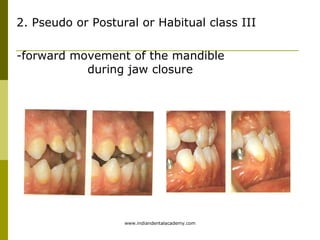 Angles Class 3 malocclusion | PPT
