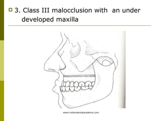 Angles Class 3 malocclusion | PPT