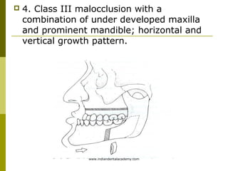 Angles Class 3 malocclusion | PPT