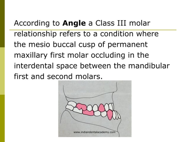Angles Class 3 malocclusion | PPT | Dental Health | Diseases and Conditions