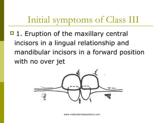 Angles Class 3 malocclusion | PPT