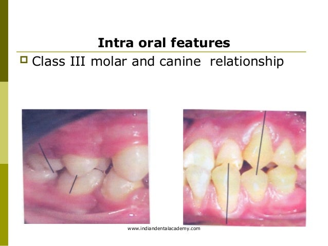 Angles Class 3 malocclusion