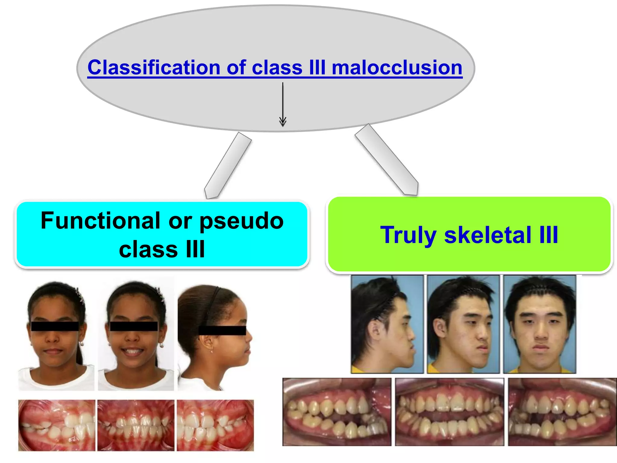 Class iii malocclsion | PPTX