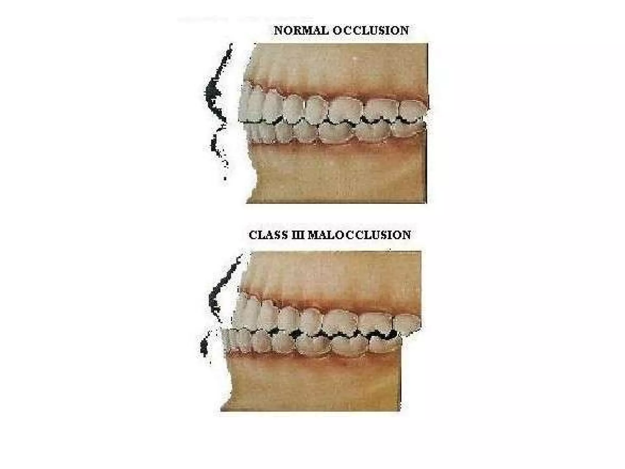 Class3malocclusion | PPT