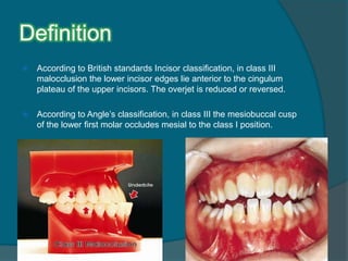 Class iii malocclusion | PPTX