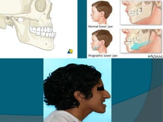 Class iii malocclusion | PPTX