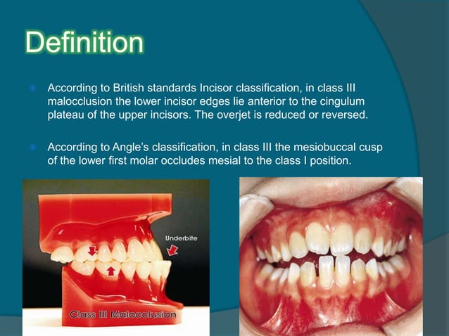 Class Iii Malocclusion Class Iii Malocclusion