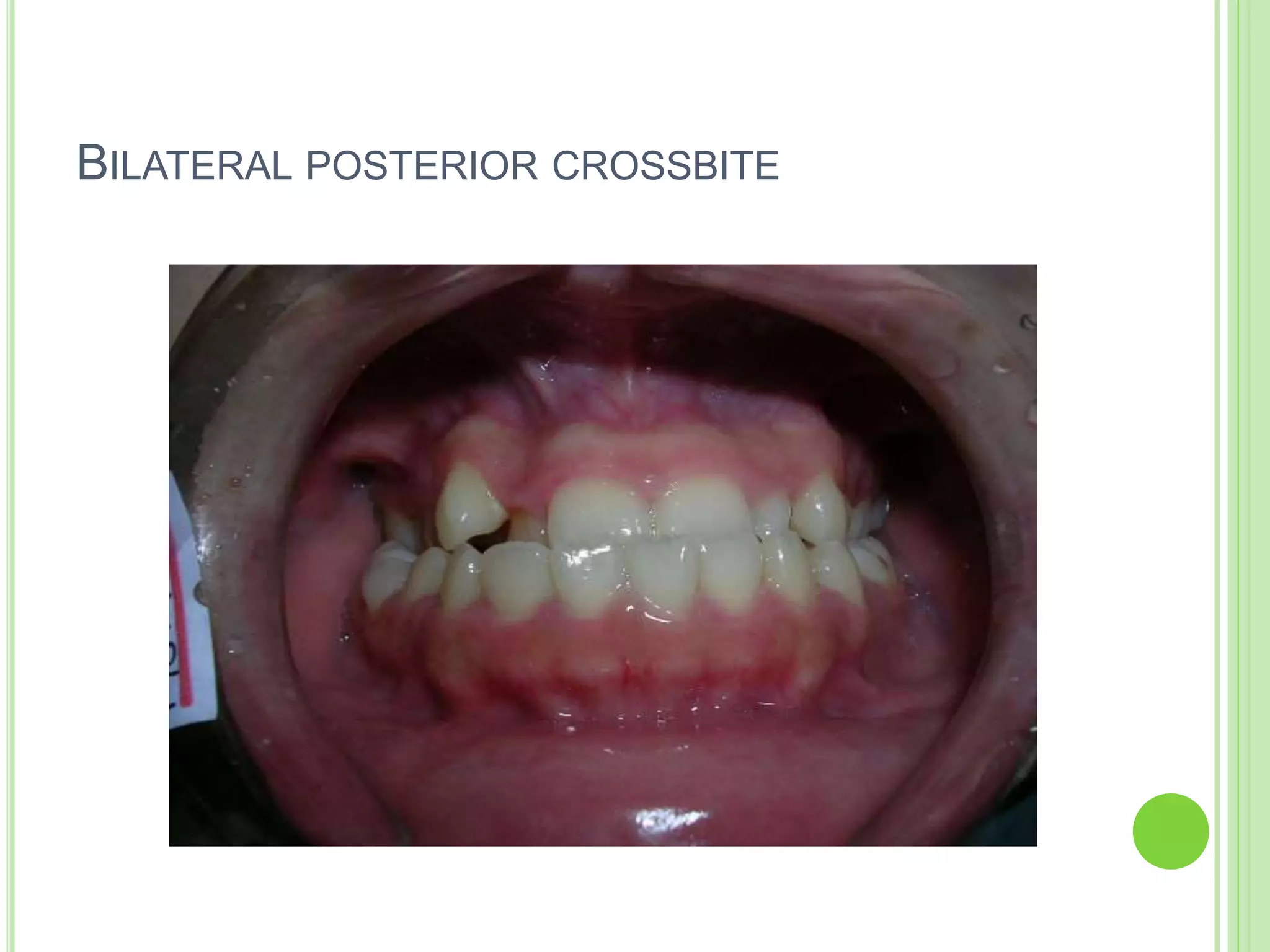 Class III Malocclusion | PPTX