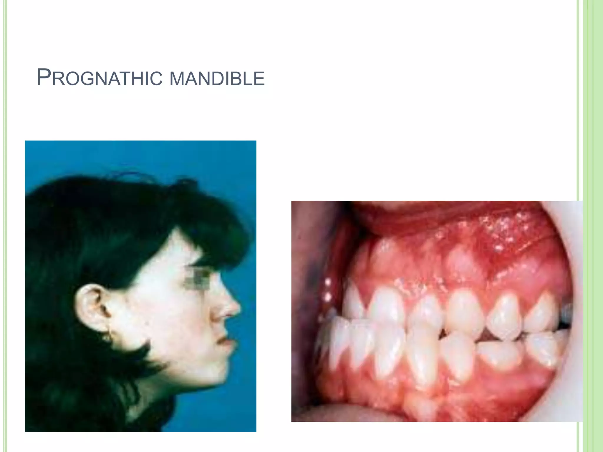 Class III Malocclusion | PPTX | Dental Health | Diseases and Conditions