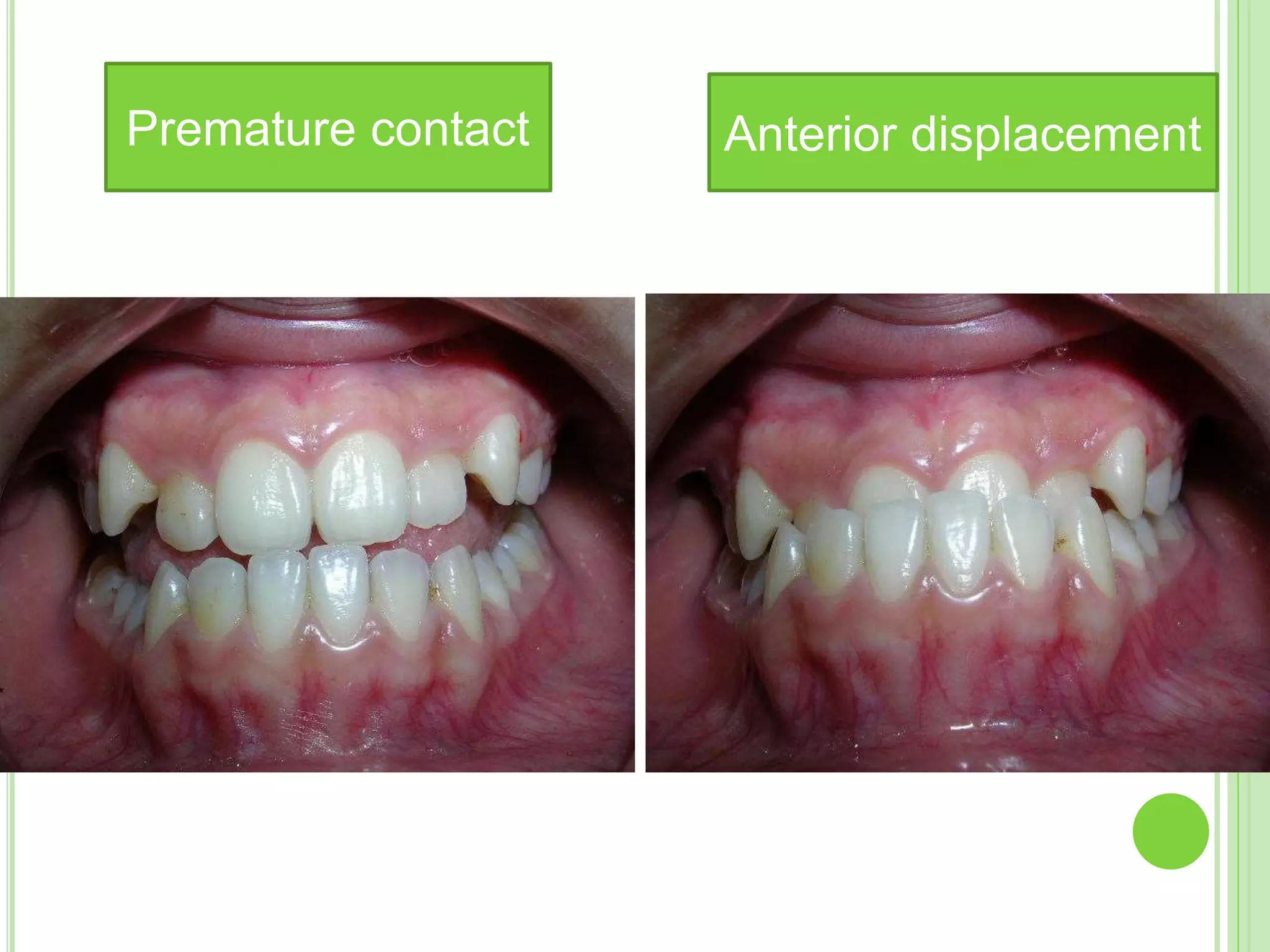 Class III Malocclusion | PPTX