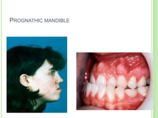 Class III Malocclusion | PPTX | Dental Health | Diseases and Conditions