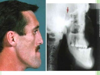 Class III Malocclusion | PPTX | Dental Health | Diseases and Conditions