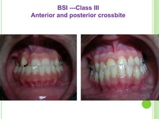 Class III Malocclusion | PPTX | Dental Health | Diseases and Conditions
