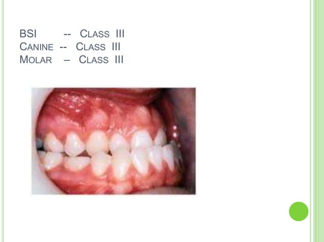 Class III Malocclusion | PPTX | Dental Health | Diseases and Conditions