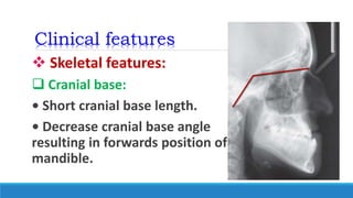 Class iii malocclusion | PPTX