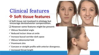 Class iii malocclusion | PPTX