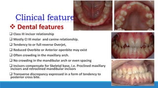 Class iii malocclusion | PPTX