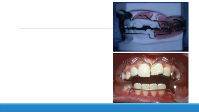 Class iii malocclusion | PPTX